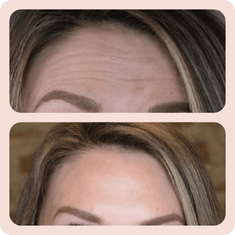 Trajtimi i rrudhave me Botox - Klinika DaVINCI